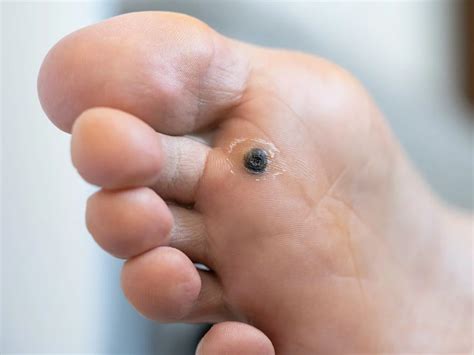 Plantar Wart Hand At Alma Jones Blog