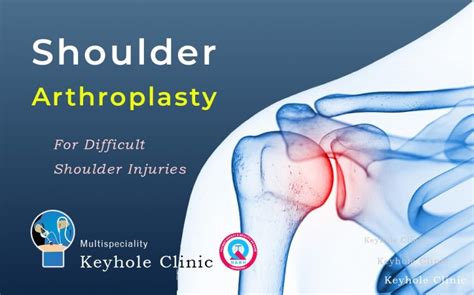 Shoulder Arthroplasty Replacement Doctors In Kochi