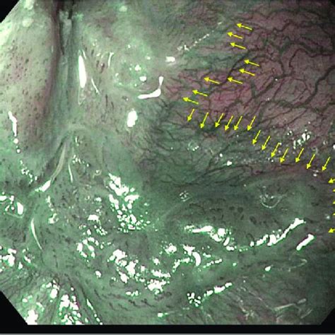 Tumor In The Upper Esophageal Sphincter And Piriform Sinus Download Scientific Diagram