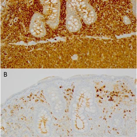 Kappa Lambda The Infiltrate Demonstrated Marked Lambda Download Scientific Diagram