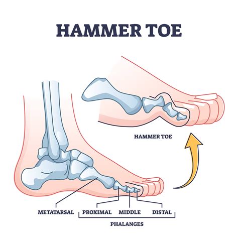 What Causes Hammer Toe The Healing Sole