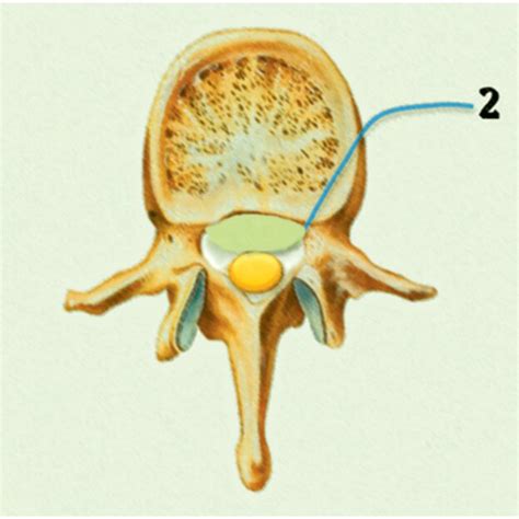 Bilski Classification Of Epidural Spinal Cord Compression Escc