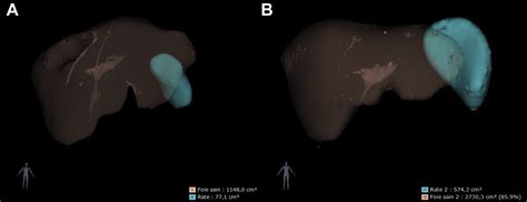 Spleen Volumetry And Liver Transient Elastography Predictors Of