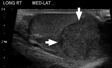 Association Between Testicular Microlithiasis And Testicular Neoplasia