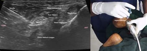 USG Guided Tibial Nerve Block In Regional Anesthesia Pain
