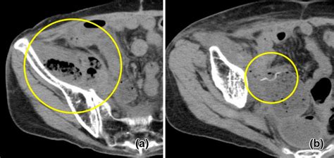 A Abdominal Ct Scan Revealed An Abscess Including Air At The Iliopsoas