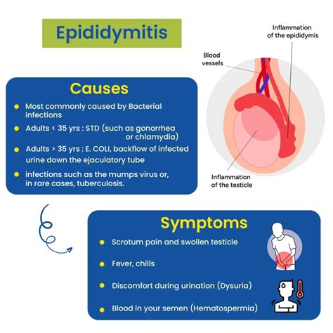 Epididymitis Symptoms Epididymitis Scrotal Pain Epididymitis