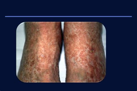 Scleroderma Disease Connective Tissues Pptx Skin And Dermatology