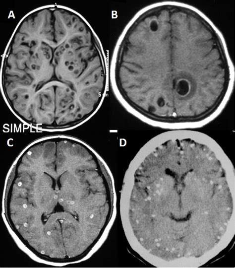 Neurocysticercosis