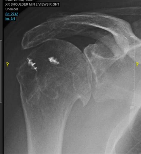 Rick Matsen On Linkedin Shoulder Shouldersurgery Shoulderreplacement Rotatorcuff Shoulders