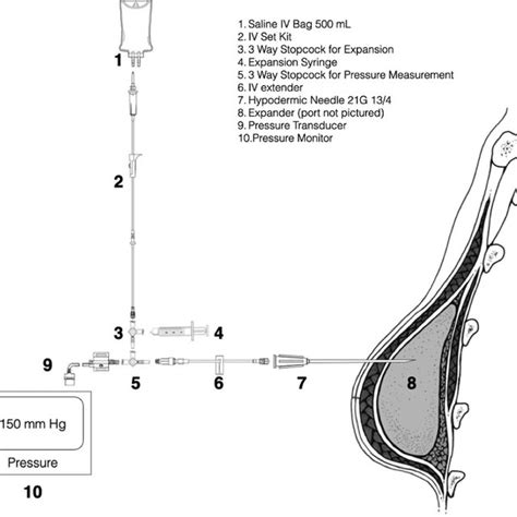 Schematic Of The Tissue Expander Fill System Used To Measure Tissue