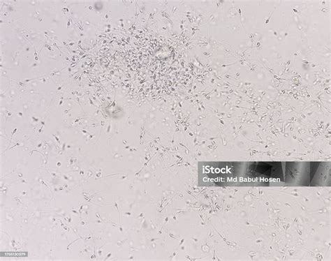 Semen Analysis Normozoospermia Analyzed By Microscope Normal Sperm
