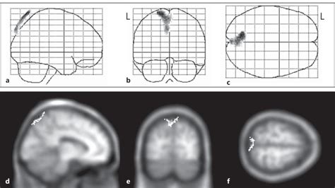 A F Spm Z Of Rcbf Decrease In Ad Patients With Poor Performance On Download Scientific