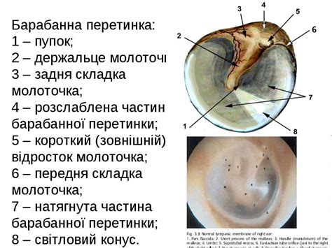Перфорированная барабанная перепонка симптомы: Перфорация перепонки ...