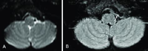 A Diffusion Weighted Imaging MRI Shows Markedly Restricted Diffusion Download Scientific