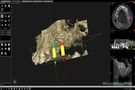 Computer Guided Surgery Raptisdentalcare