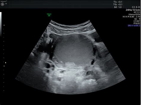 Retrograde Menstruation And Endometriosis Cause Or Factor Empowered Womens Health