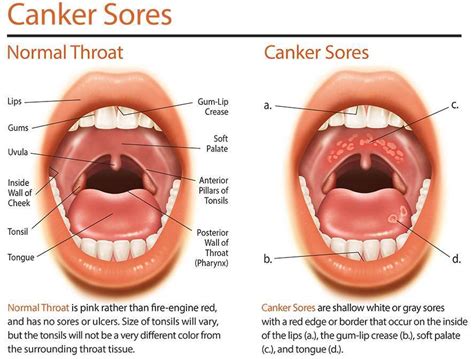 Canker Sore In Throat Remedy