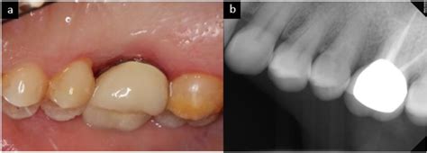 Permanent Crown Delivery A Intraoral And B Radiological Views