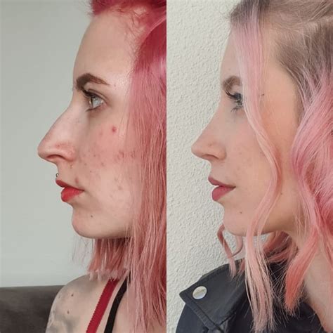 Honey Helped My Last Bruises From Rhinoplasty Plasticsurgery