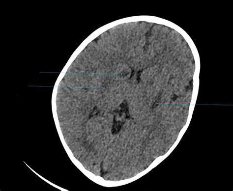 Axial Ct Brain Symmetrical Hypodensities In The Bilateral Caudate