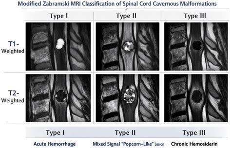 Spinal Cavernous Malformations A Narrative Review