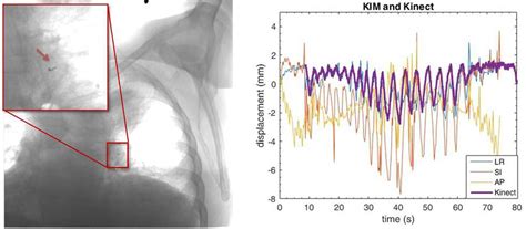 P205 043 Lung Tumor Motion Kilovoltage Intrafraction Monitoring Kim First Clinical Results