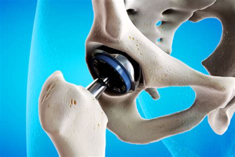 Metal Ions From Joint Implants And Bone Health Prime Magazine