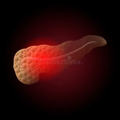 Ejemplo de la pancreatitis ilustración del vector. Ilustración de sano - 82434552