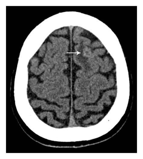 Choriocarcinoma With Widespread Metastases Presenting With Seizures