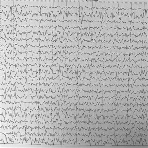 Initial Electroencephalogram Eeg Showing Diffuse Low Voltage In Both Download Scientific