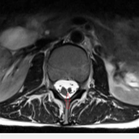 Axial T2 Magnetic Resonance Imaging Scan Showing A Split Cord Download Scientific Diagram
