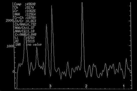 Monovoxel Spectroscopy On Frontal Wm Abnormalities Shows Decrease Of