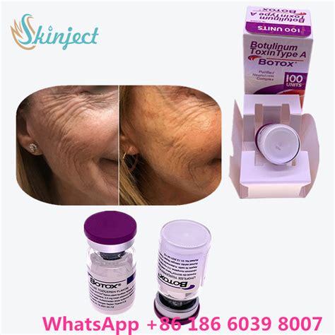 Allergan Botox Botulinum Toxin Type A For Skin Anti Aging Products