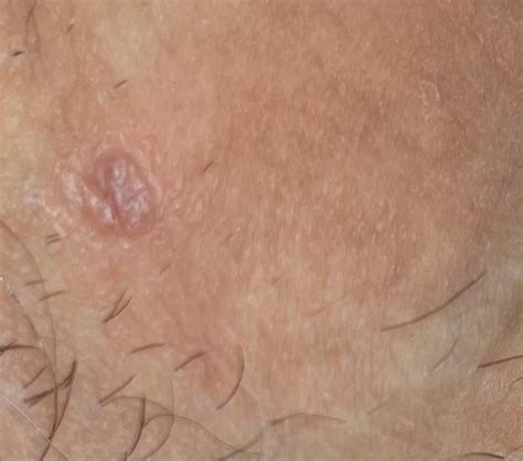 Weird Skin Patch Rmelanoma