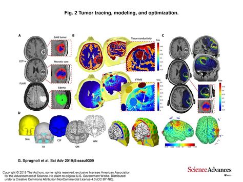 Fig 2 Tumor Tracing Modeling And Optimization Ppt Download