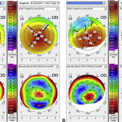 Pdf Keratoconus Progression Associated With Hormone Replacement Therapy