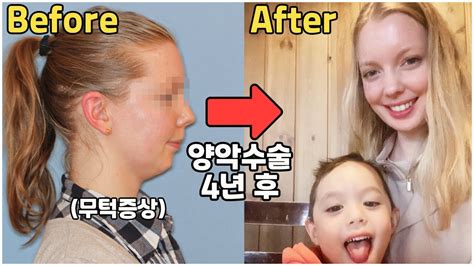 헝가리부부 무턱 증상으로 양악수술후 4년만에 치아교정기를 빼고 건강한 미소를 되찾은 헝가리아내😄 ️ 양악수술 국제가족