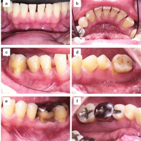 Visual Assessment Scale The Tool Used To Score Severity Of Pd Download Scientific Diagram