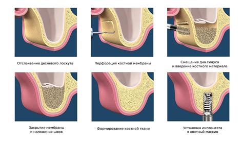 Синус-лифтинг в СПб: цены и преимущества разных методик | Axioma Dental