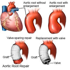 Aortic Root Full Article Progress In Surgical Interventions For
