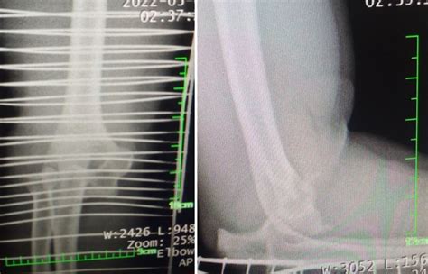 Unusual Posterior Elbow Dislocation Associated With Radial Head