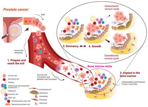 Bone Metastases And Health In Prostate Cancer From Pathophysiology To