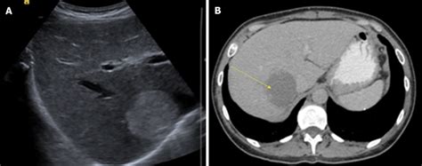 Cavernous Hemangioma Liver Ultrasound