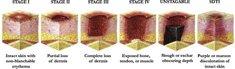Decubitus Ulcer Staging Pressure Ulcer Stages Help Grepmed 57 Off
