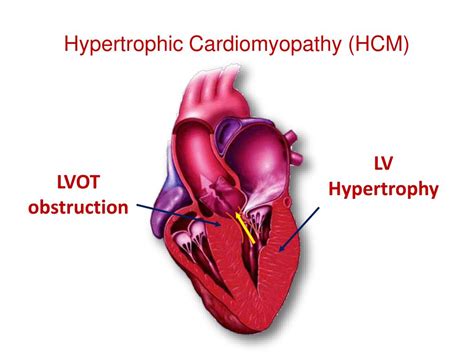 Ppt Cardiomyopathies Andre Keren Md Powerpoint Presentation Free