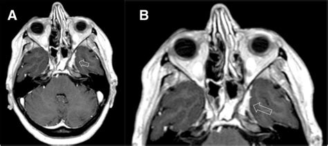 Imaging Of Cranial Nerves A Pictorial Overview Pmc