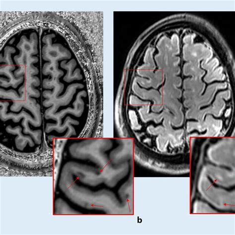 8 A Number Of Cortical Lesions In A Patient With Multiple Sclerosis 39 Download Scientific
