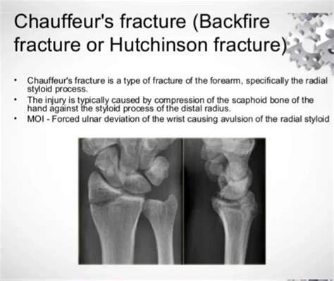 Chauffeur Fracture Xray Medical Radiologia