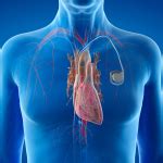 Insertion Of A Pacemaker Or Defibrillator Device Monash Heart Private